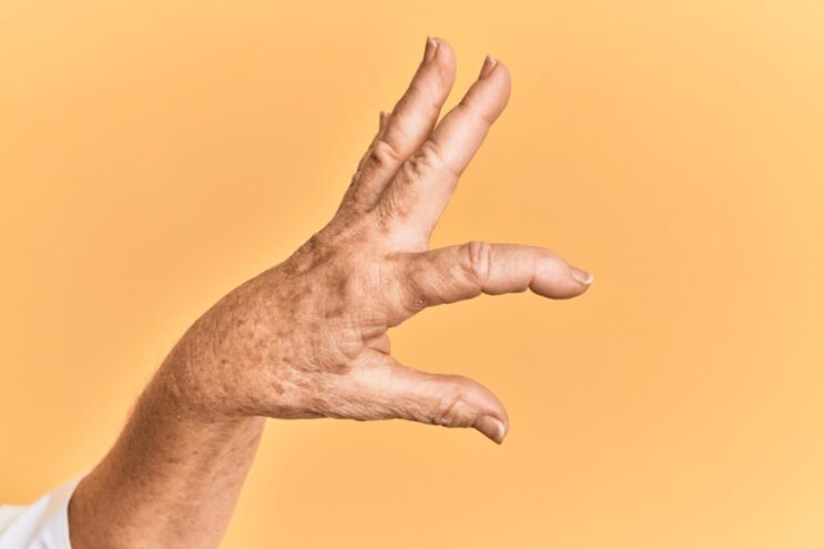 Hand Rejuvenation: Tips and Techniques for Age Spot Removal - Your ...